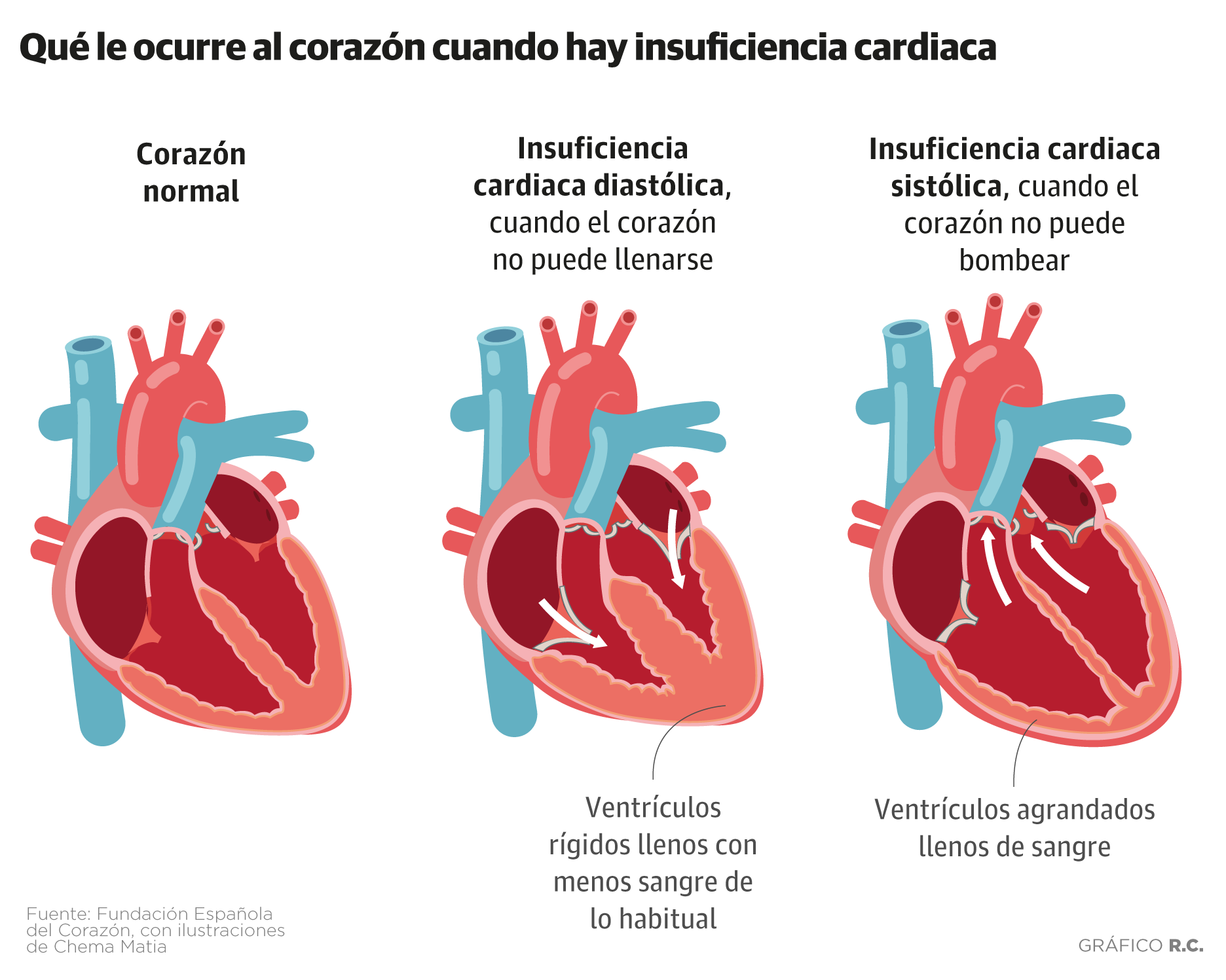Insuficiencia cardiaca, la importancia de fortalecer el corazón | El Correo